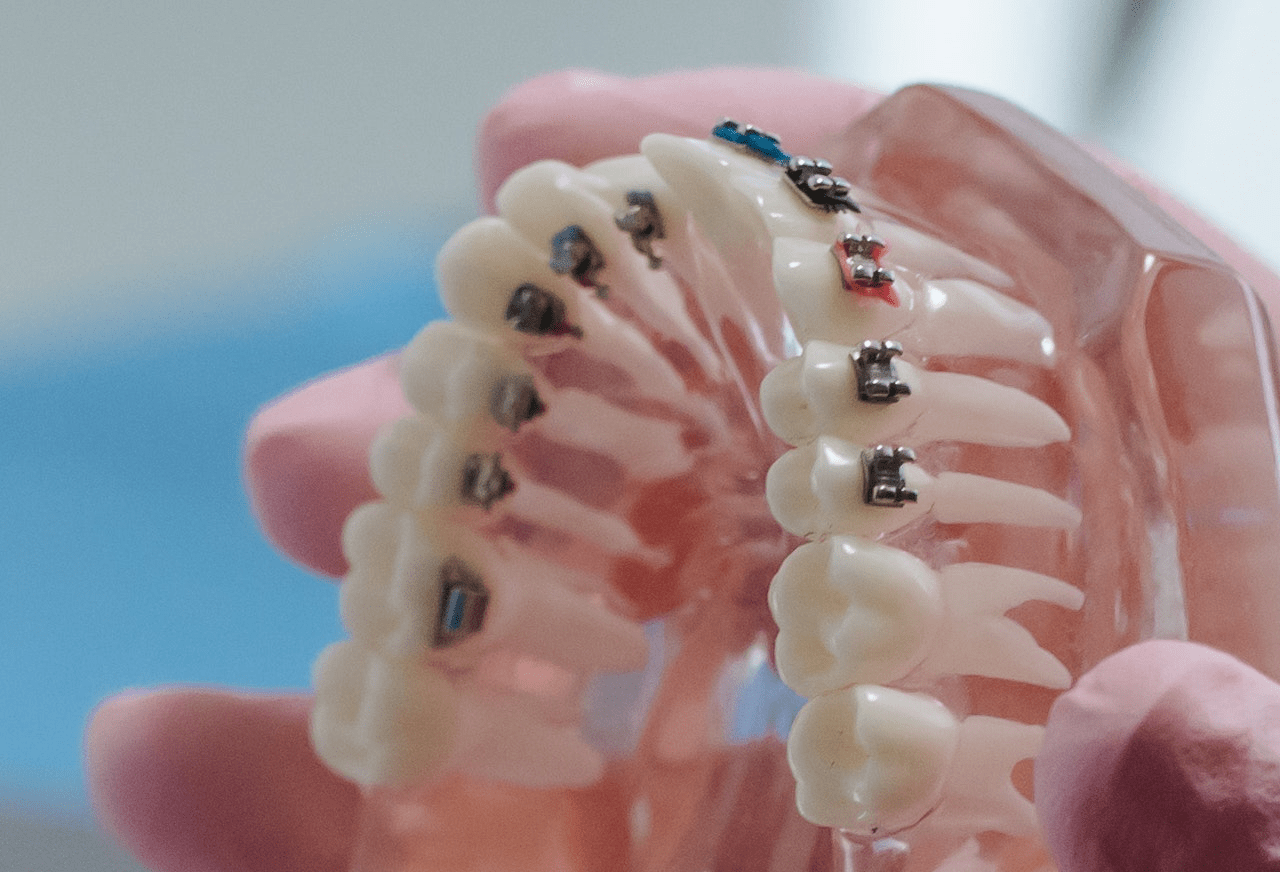 Different Types of Braces for Teeth | Skarin Orthodontics