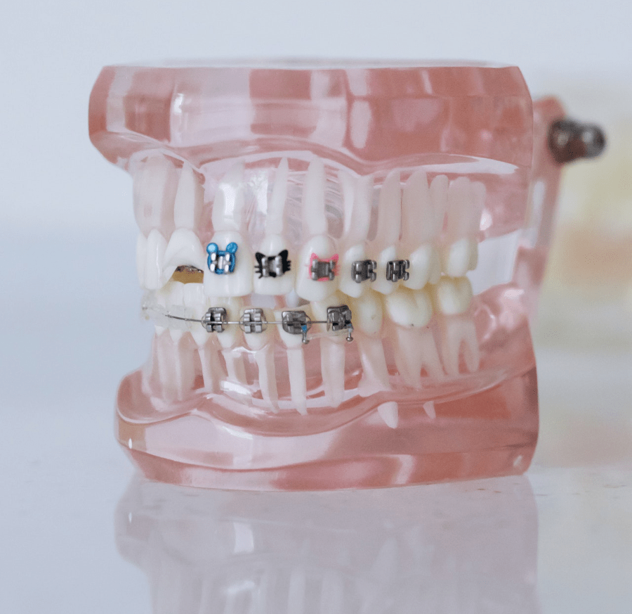 Types of Braces for Straightening Teeth | Skarin Orthodontics